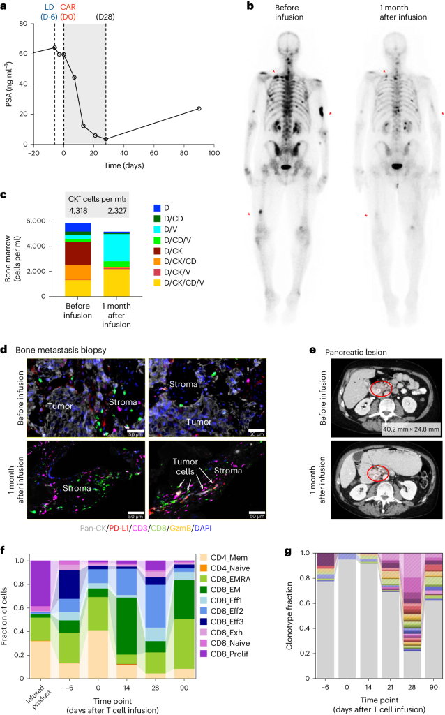 CAR-T Cells Targeting PSCA Show Promise in Treating Metastatic ...