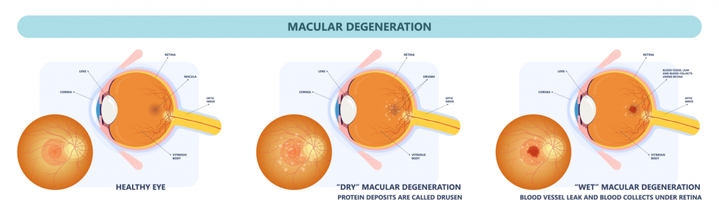 A Ground-Breaking Complement Therapy for Geographic Atrophy (GA ...
