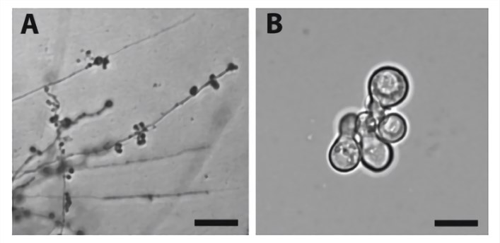 Blastomyces Dermatitidis