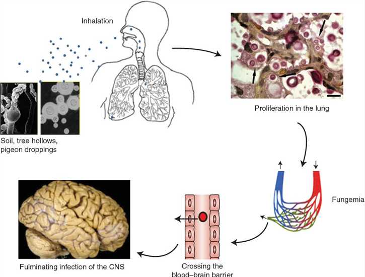 Cryptococcus Brain