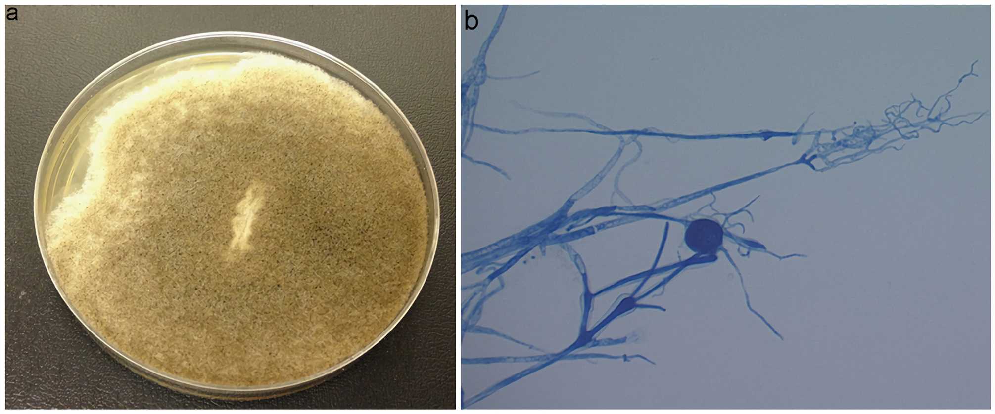 Rhizomucor Spp Mucormycosis: What You Should Know – NHI