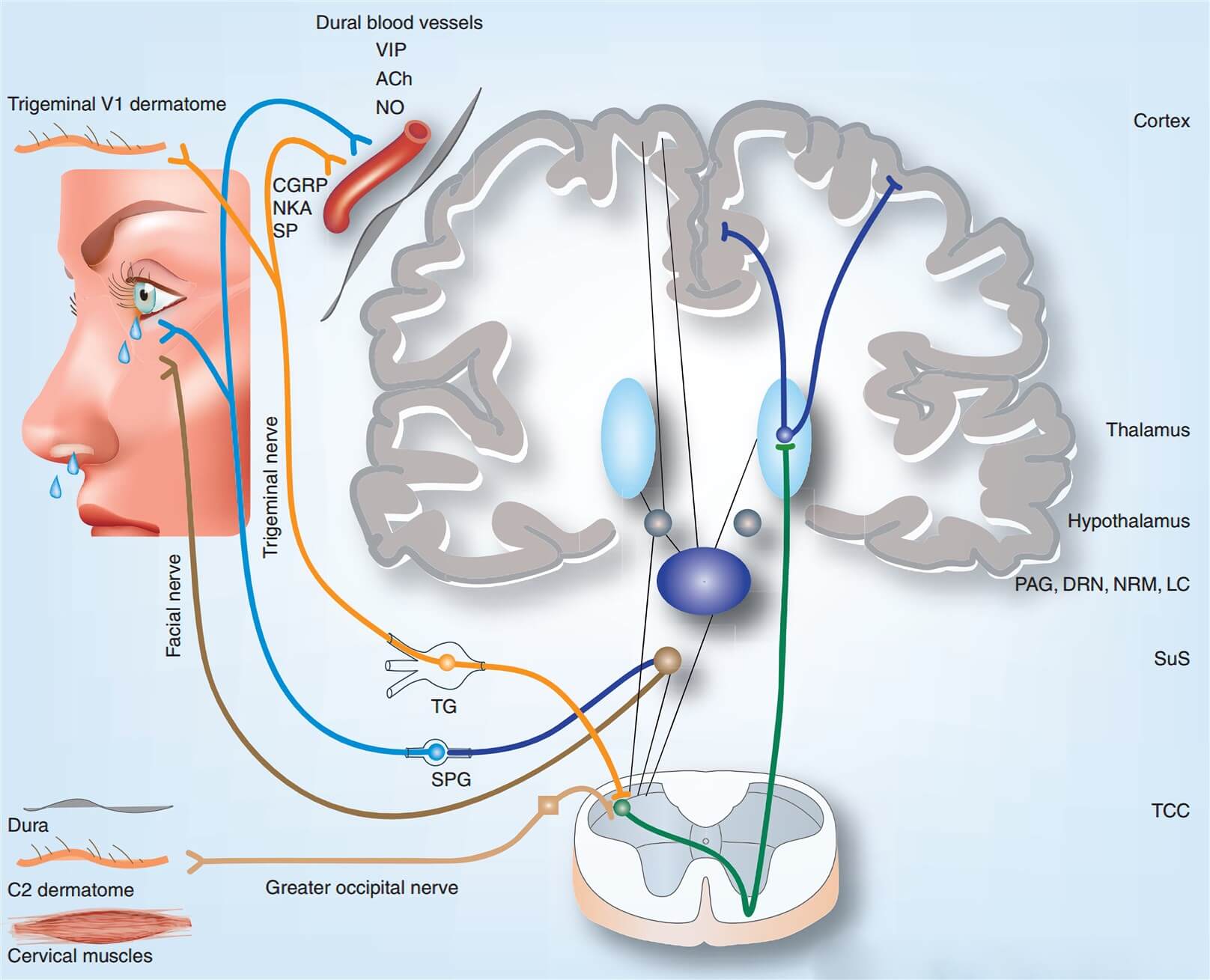Maxillary Nerve Migraine